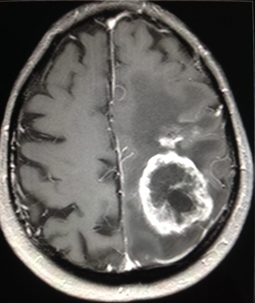 Glioma – The Common Brain Tumour – Hannah Joseph Hospital