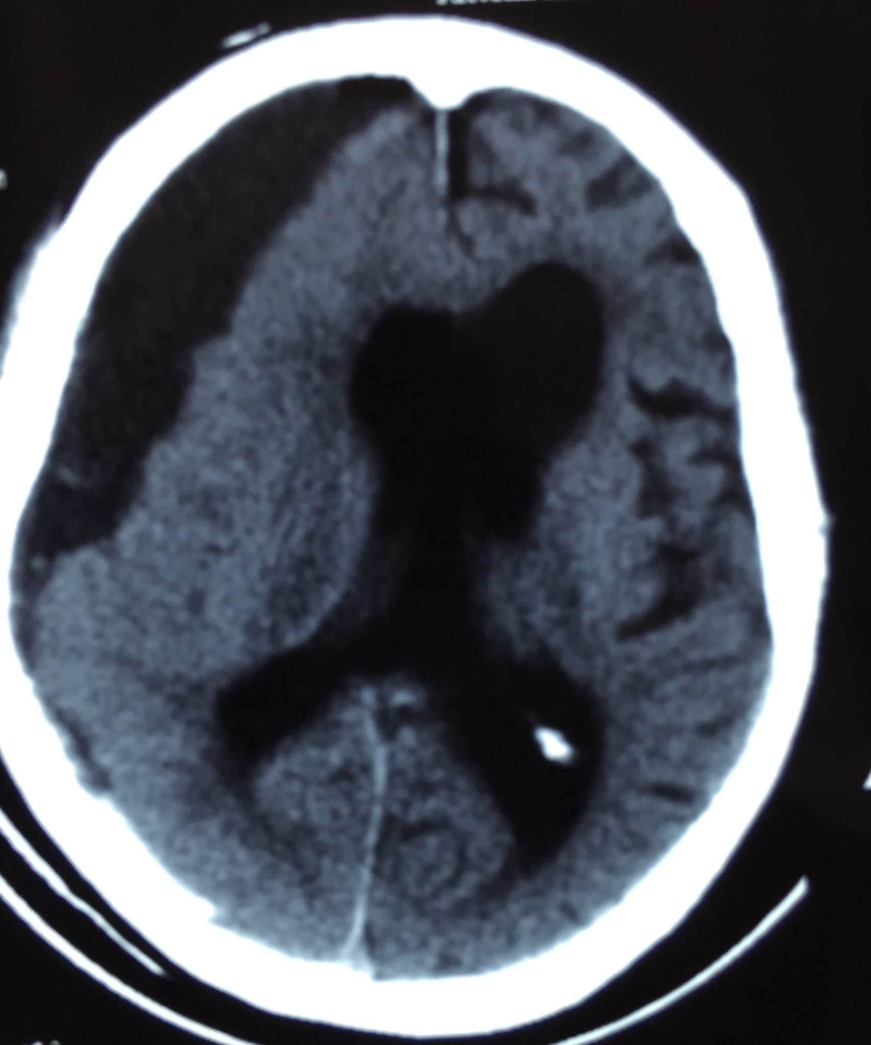 Dementia – The Reversible Causes – Hannah Joseph Hospital