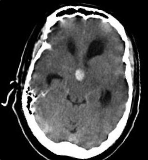 Colloid Cyst – A Benign Cyst Of The Brain – Hannah Joseph Hospital